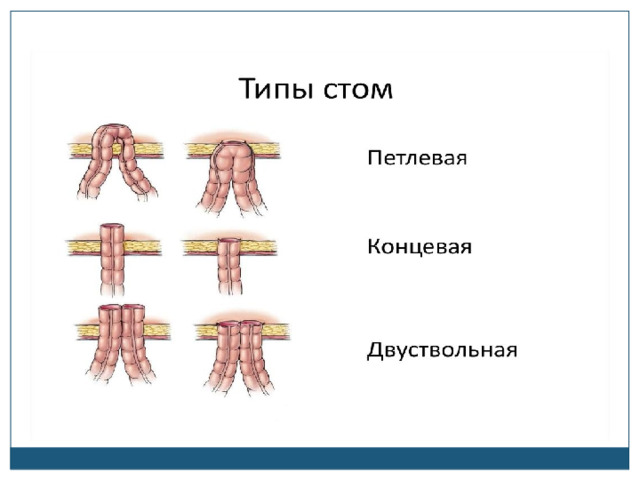 Презентация "Стома. Уход за стомой."