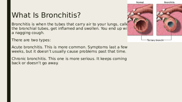 What Is Bronchitis?